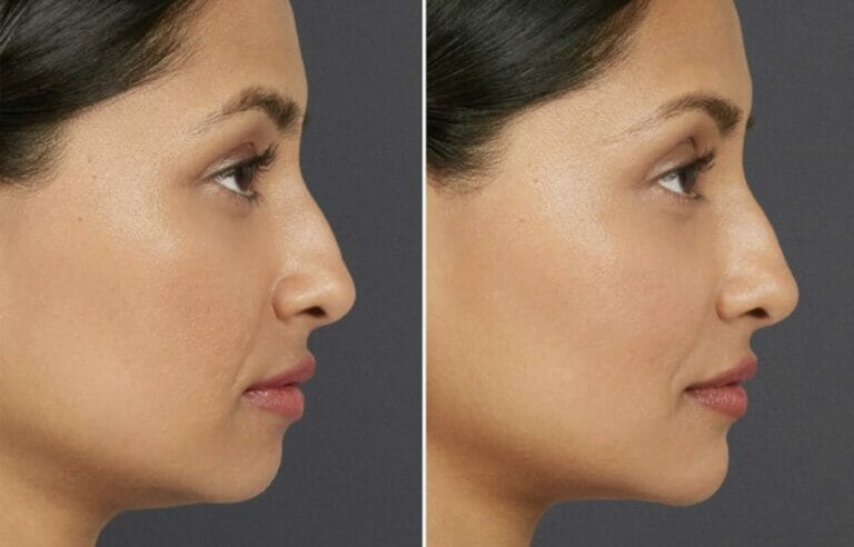 Recessed Chin | Allura Skin, Laser & Wellness Clinic | Fort Collins ...